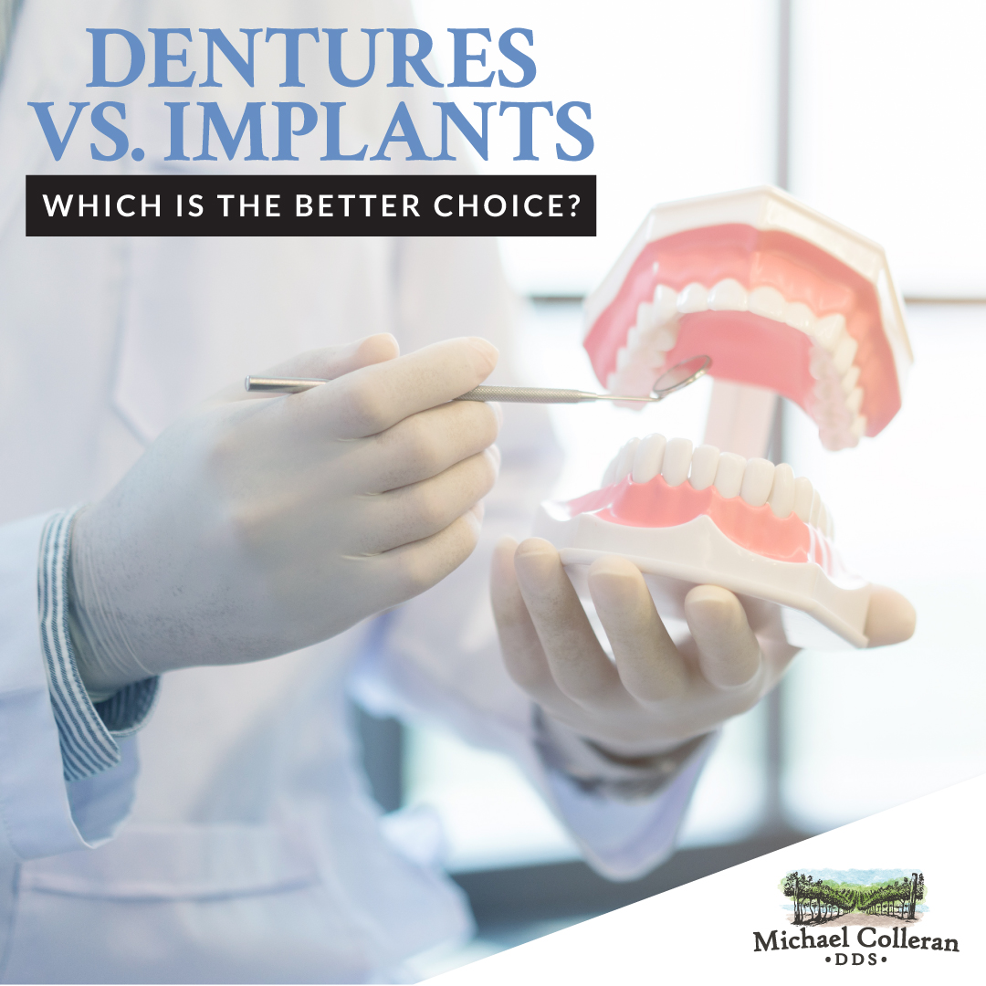 Dentures vs Implants in San Luis Obispo, CA | Michael Colleran, DDS